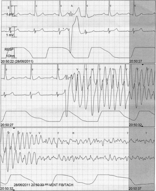 Ventricular fibrillation, pulseless electrical activity and sudden ...