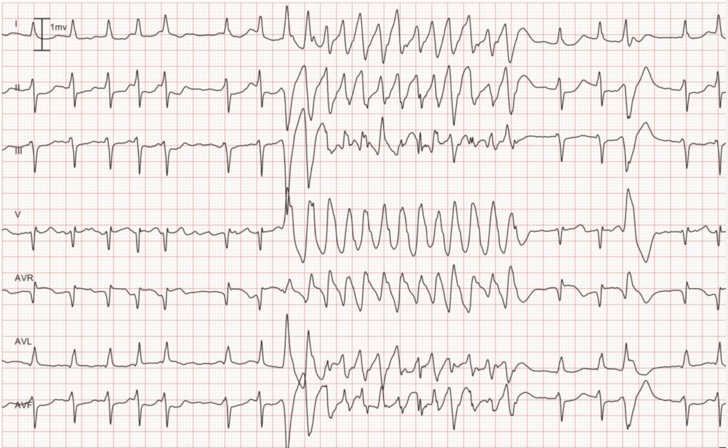 Ventricular tachycardia (VT): ECG criteria, causes, classification ...