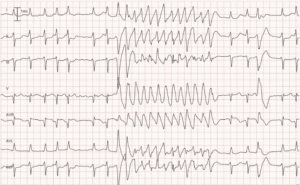 Ventriculaire tachycardie (VT): ECG-criteria, oorzaken, classificatie ...