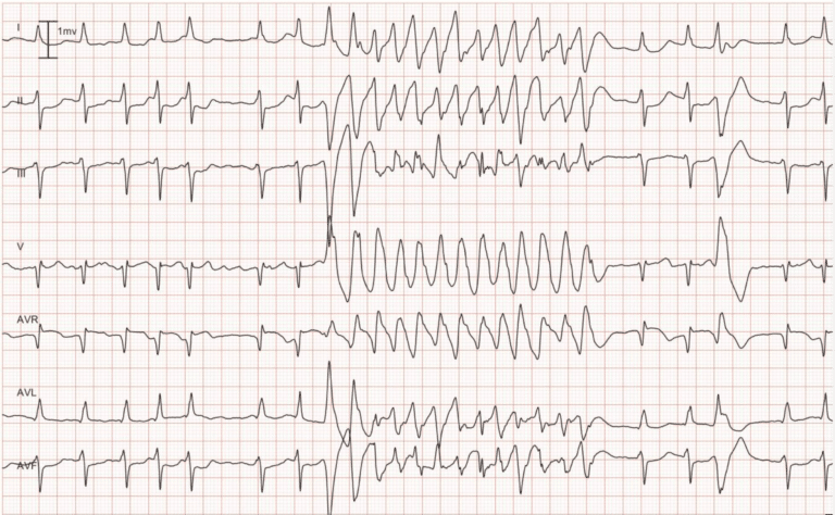 Ventricular tachycardia (VT): ECG criteria, causes, classification ...