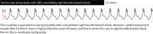 Ventricular tachycardia (VT): ECG criteria, causes, classification ...