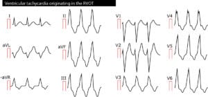 Ventricular tachycardia (VT): ECG criteria, causes, classification ...