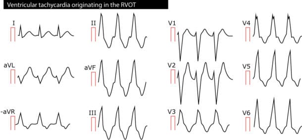 Ventricular tachycardia (VT): ECG criteria, causes, classification ...