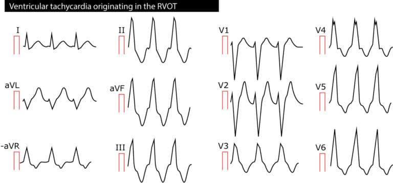 Ventricular tachycardia (VT): ECG criteria, causes, classification ...