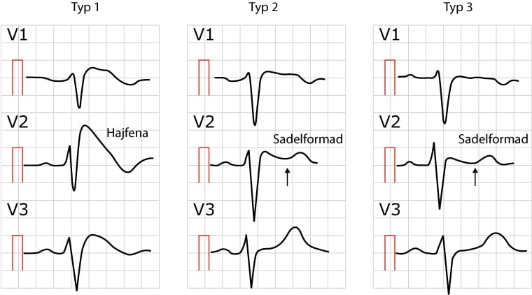 Ecg Litfl Sinus Basics Bifascicular Axis Tachycardia Fascicular ...