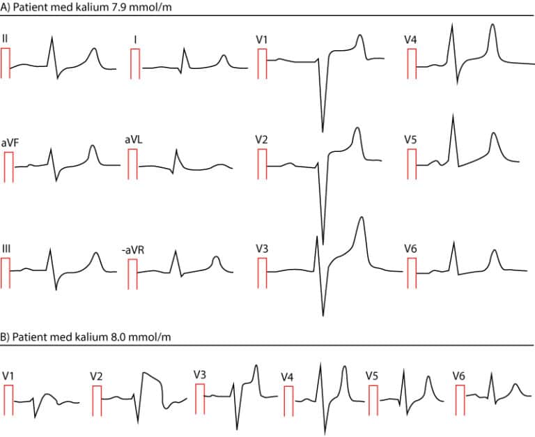 Hyperkalemi – ECG learning