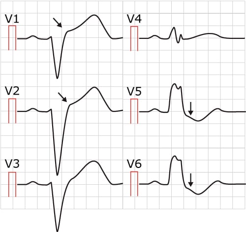 Vänstergrenblock – ECG learning