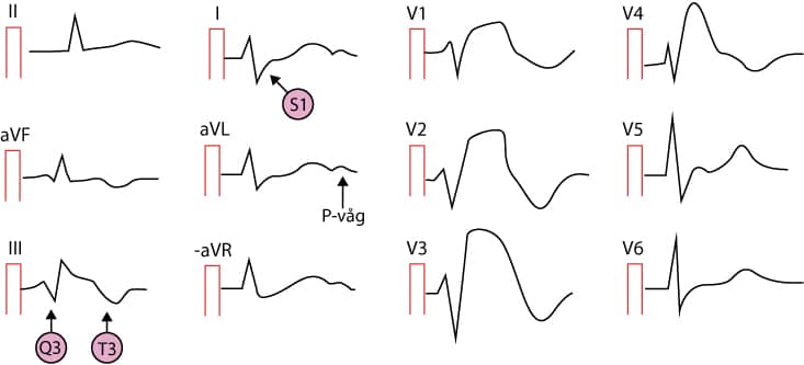 Lungemboli – ECG learning