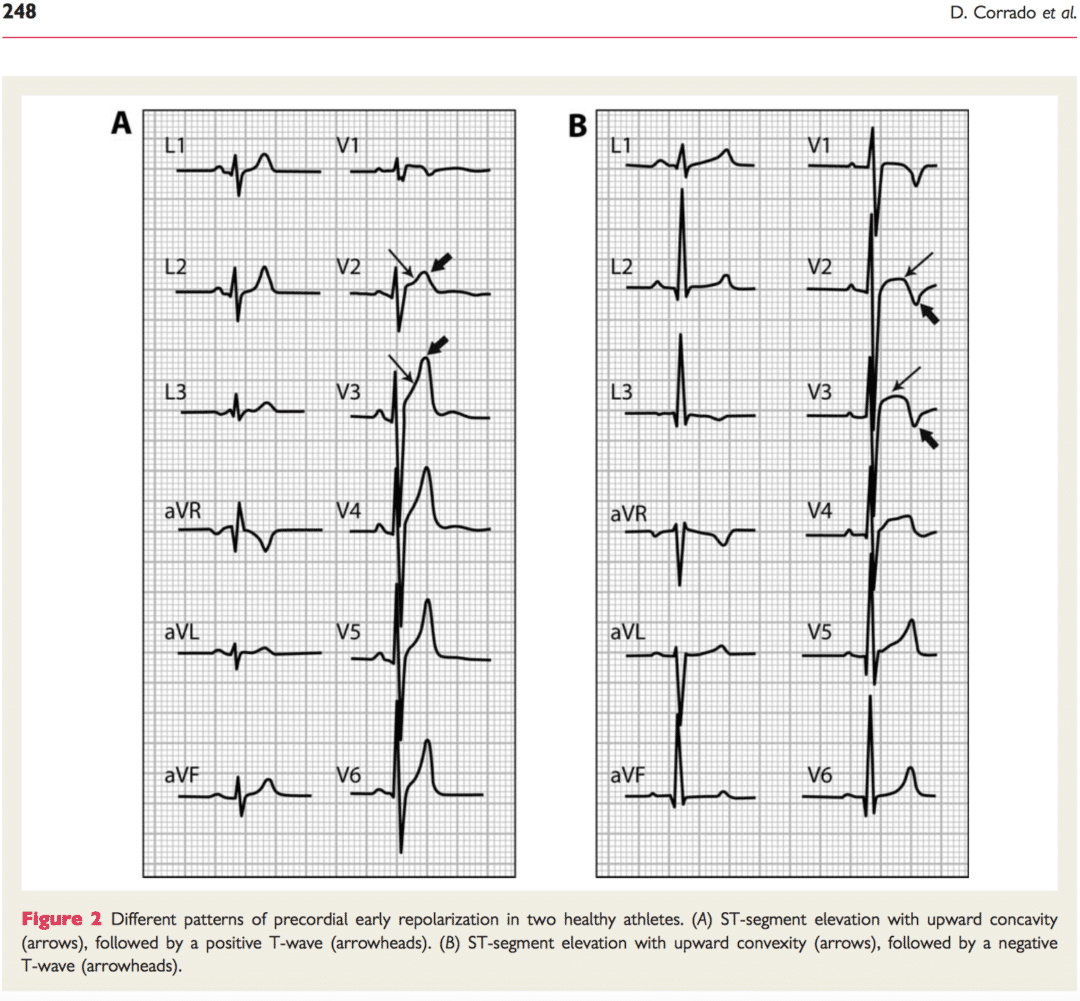 Early repolarization on ECG: when guidelines confuse ECG criteria