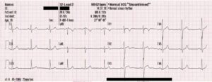 The Cabrera format of the 12-lead ECG and inverted lead aVR – The ...