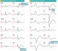 Right bundle branch block (RBBB): ECG, criteria, definitions, causes ...