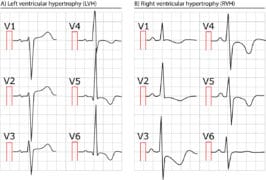 Right ventricular hypertrophy (RVH): ECG criteria & clinical ...