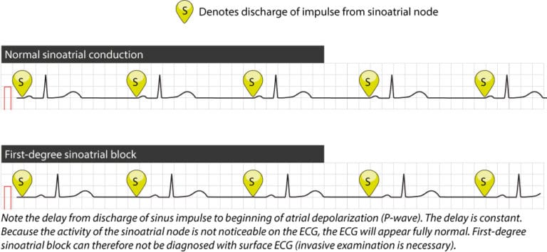 Sinoatrial block (SA block): ECG criteria, causes and clinical features ...