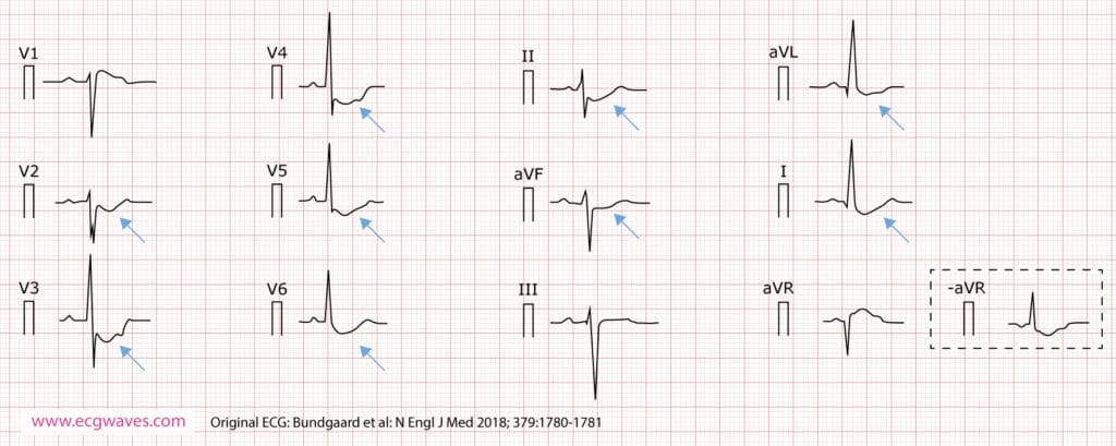 ST segment depression in myocardial ischemia and differential diagnoses ...
