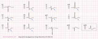 ST segment depression in myocardial ischemia and differential diagnoses ...
