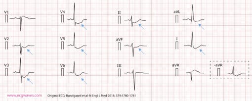 ST segment depression in myocardial ischemia and differential diagnoses ...