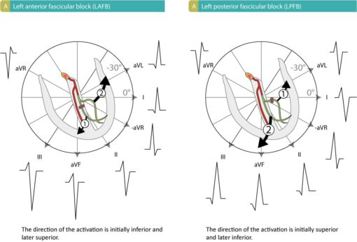 Fascicular block (hemiblock): left anterior & left posterior fascicular ...