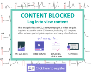Sinoatrial block (SA block): ECG criteria, causes and clinical features ...