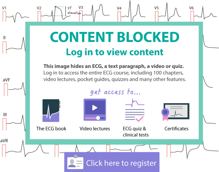 Sinoatrial block (SA block): ECG criteria, causes and clinical features ...