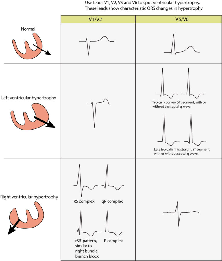 Biventricular hypertrophy ECG and clinical characteristics – The ...