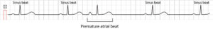 Premature atrial contraction (premature atrial beat / complex): ECG and ...