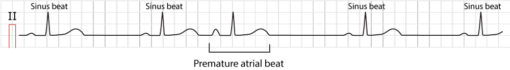 Premature atrial contraction (premature atrial beat / complex): ECG and ...