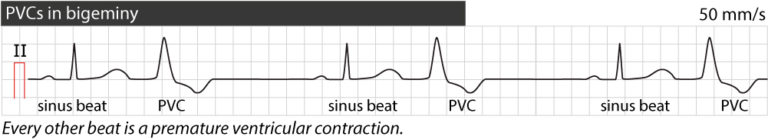 Premature ventricular contractions (premature ventricular complex ...