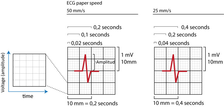 The ECG leads: electrodes, limb leads, chest (precordial) leads, 12 ...