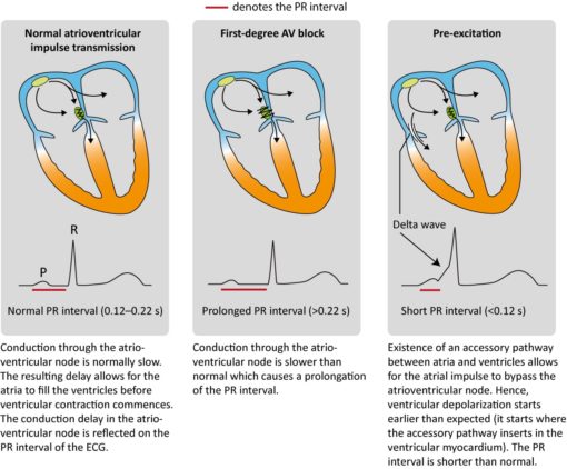 P-wave, PR interval, PR segment: physiology, criteria & ECG findings