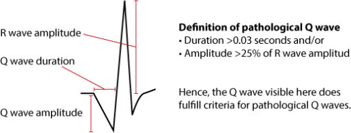 The QRS complex: ECG features of the Q-wave, R-wave, S-wave & duration