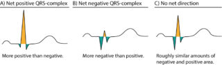 The QRS complex: ECG features of the Q-wave, R-wave, S-wave & duration