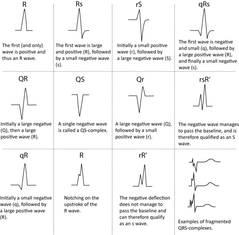 ECG interpretation: Characteristics of the normal ECG (P-wave, QRS ...