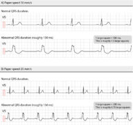 The QRS complex: ECG features of the Q-wave, R-wave, S-wave & duration