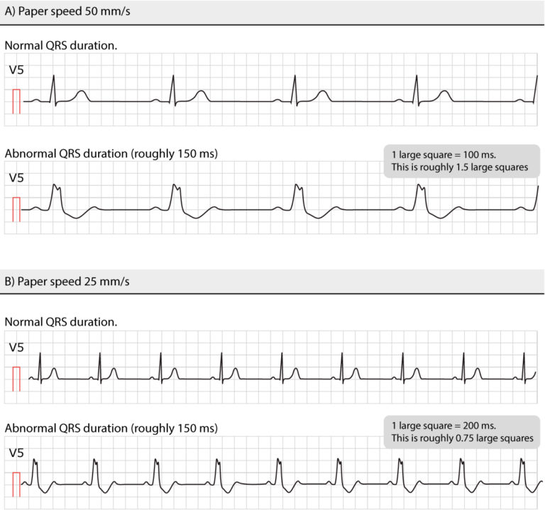 The QRS complex: ECG features of the Q-wave, R-wave, S-wave & duration