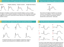 The ST segment: physiology, normal appearance, ST depression & ST ...