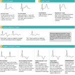 The T-wave: physiology, variants and ECG features – ECG & ECHO