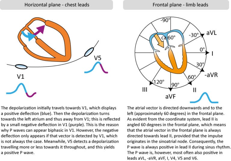 P-wave, PR interval, PR segment: physiology, criteria & ECG findings