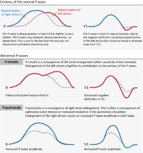 P-wave, PR interval, PR segment: physiology, criteria & ECG findings