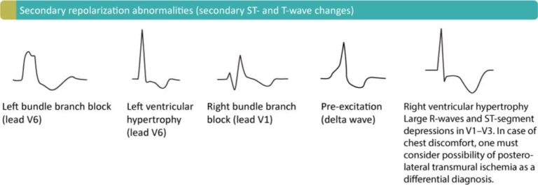 T-waves in ischemia: hyperacute, inverted (negative), Wellen's sign ...
