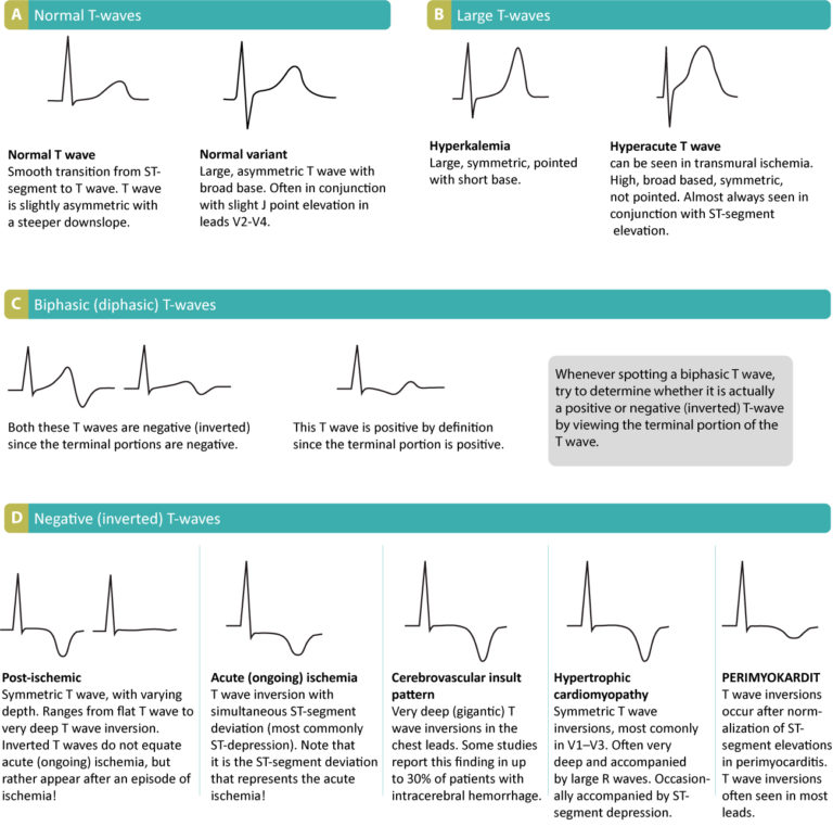 T-waves in ischemia: hyperacute, inverted (negative), Wellen's sign ...