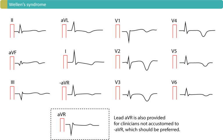 T-waves in ischemia: hyperacute, inverted (negative), Wellen's sign ...