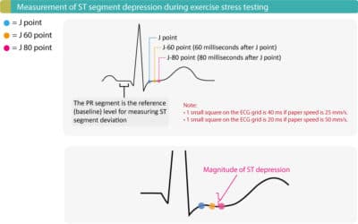 Evaluation of exercise stress test: ECG, symptoms, blood pressure ...