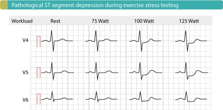 Evaluation of exercise stress test: ECG, symptoms, blood pressure ...
