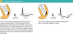 Evaluation of exercise stress test: ECG, symptoms, blood pressure ...