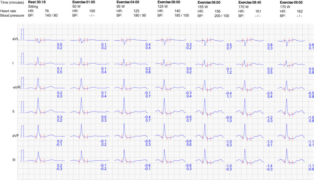 Evaluation of exercise stress test: ECG, symptoms, blood pressure ...