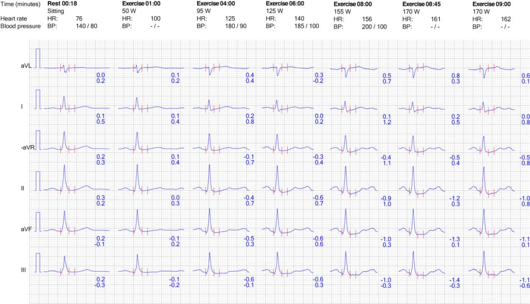 Evaluation of exercise stress test: ECG, symptoms, blood pressure ...