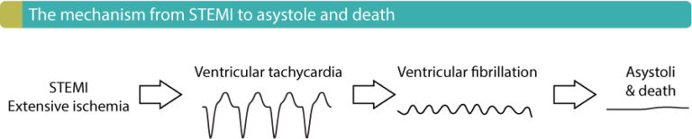 STEMI (ST Elevation Myocardial Infarction): diagnosis, criteria, ECG & management – ECG & ECHO