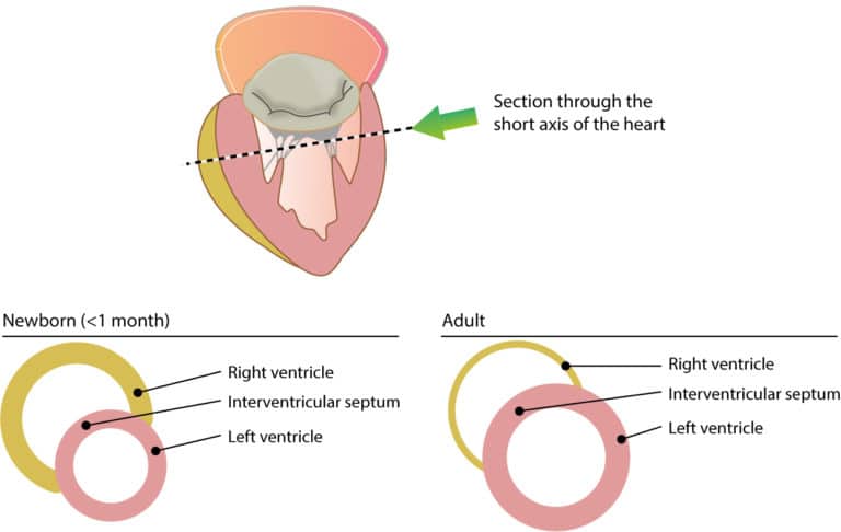 Introduction to pediatric & neonatal ECG interpretation – The ...