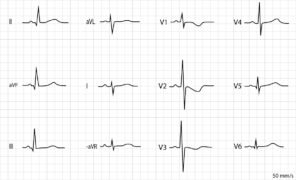 Introduction to pediatric & neonatal ECG interpretation