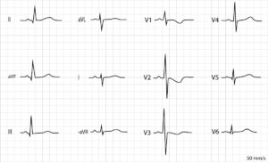 Introduction to pediatric & neonatal ECG interpretation